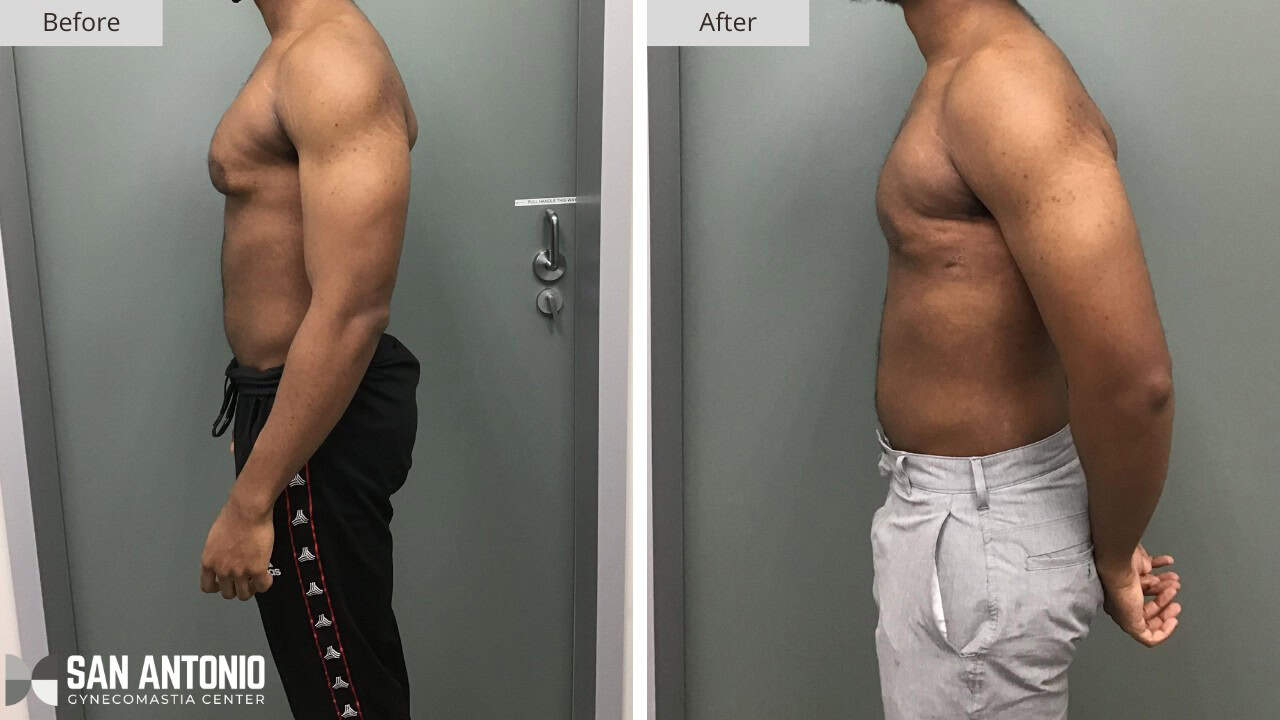 San Antonio Gynecomastia Surgery: Before & After Results